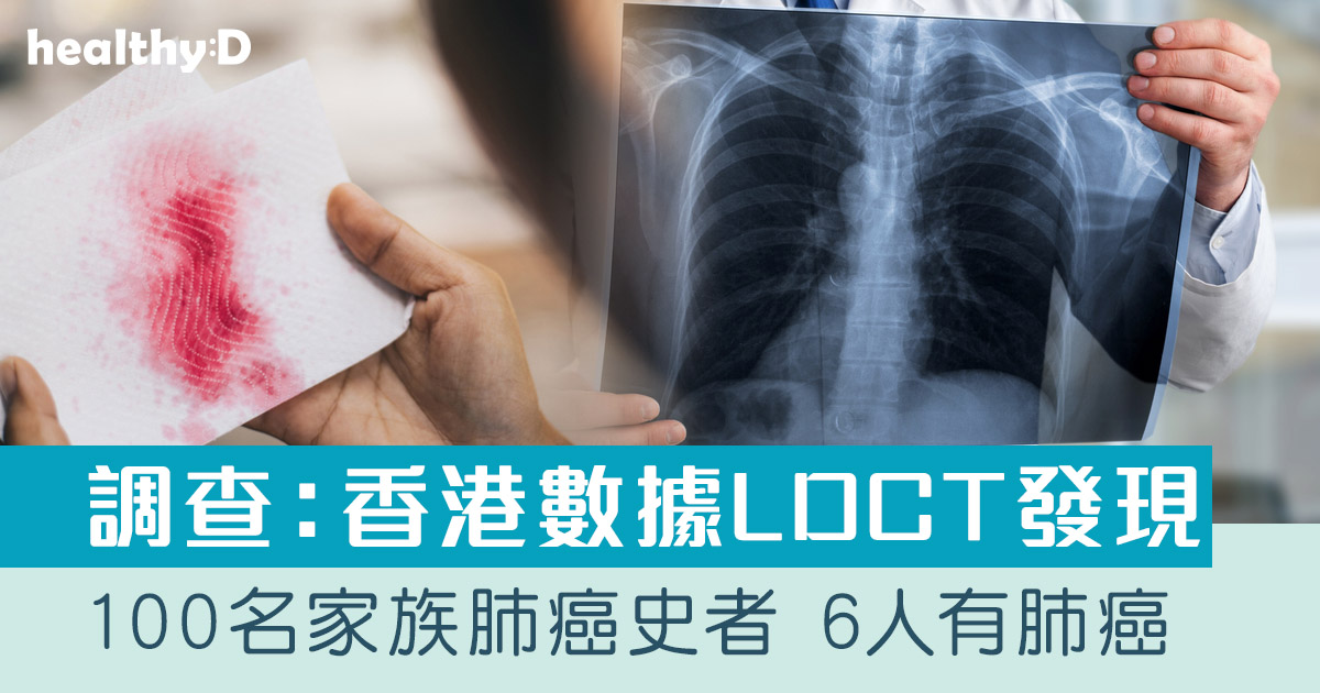 世界肺癌關注月｜調查：香港數據LDCT發現100名有家族肺癌史的人士中6名為肺癌陽性 | healthyD.com